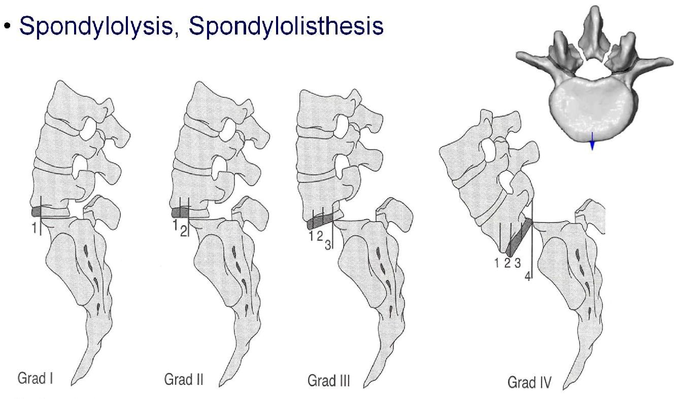 Bauerfeind Srbija » Spondylolisthezis i ortoze